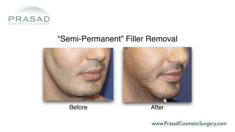 Cheek Filler Before and After, and What You Need to Know