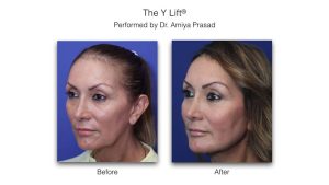 Cheek Filler Before and After, and What You Need to Know