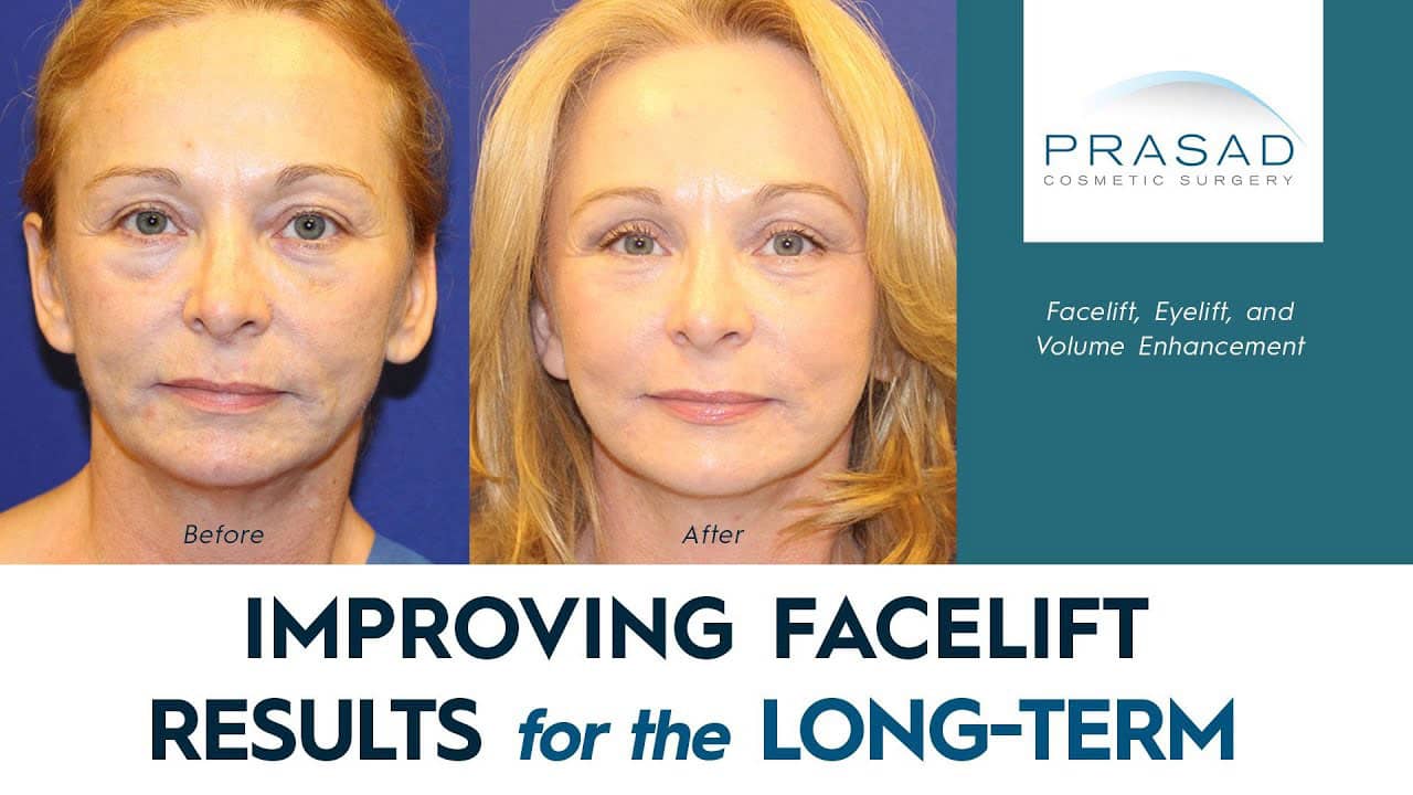 How to Improve Your Facelift Results | Dr. Prasad Blog