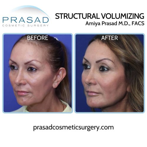 Cheek Filler Before and After, and What You Need to Know