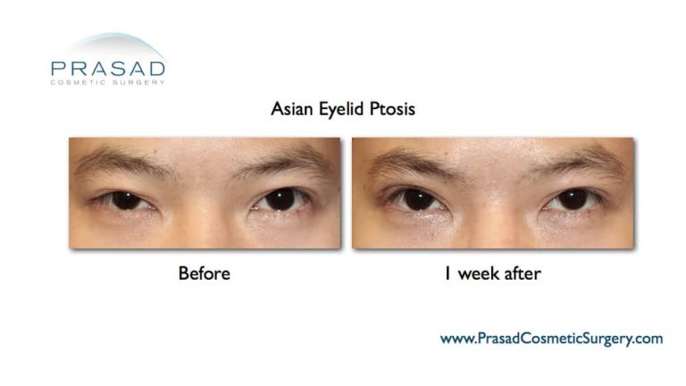 Asymmetrical Eyes - When Surgery is Recommended | Dr. Prasad