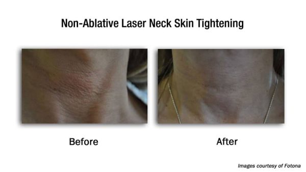 How to Tighten Neck Skin? Surgical and Non-Surgical Options