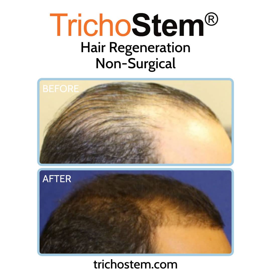 Delayed Hair Growth and Hair Loss After Hair Transplant