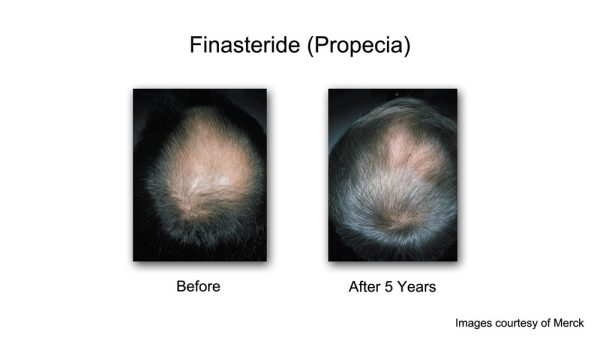 Understanding the Benefits and Risks of Finasteride in Women