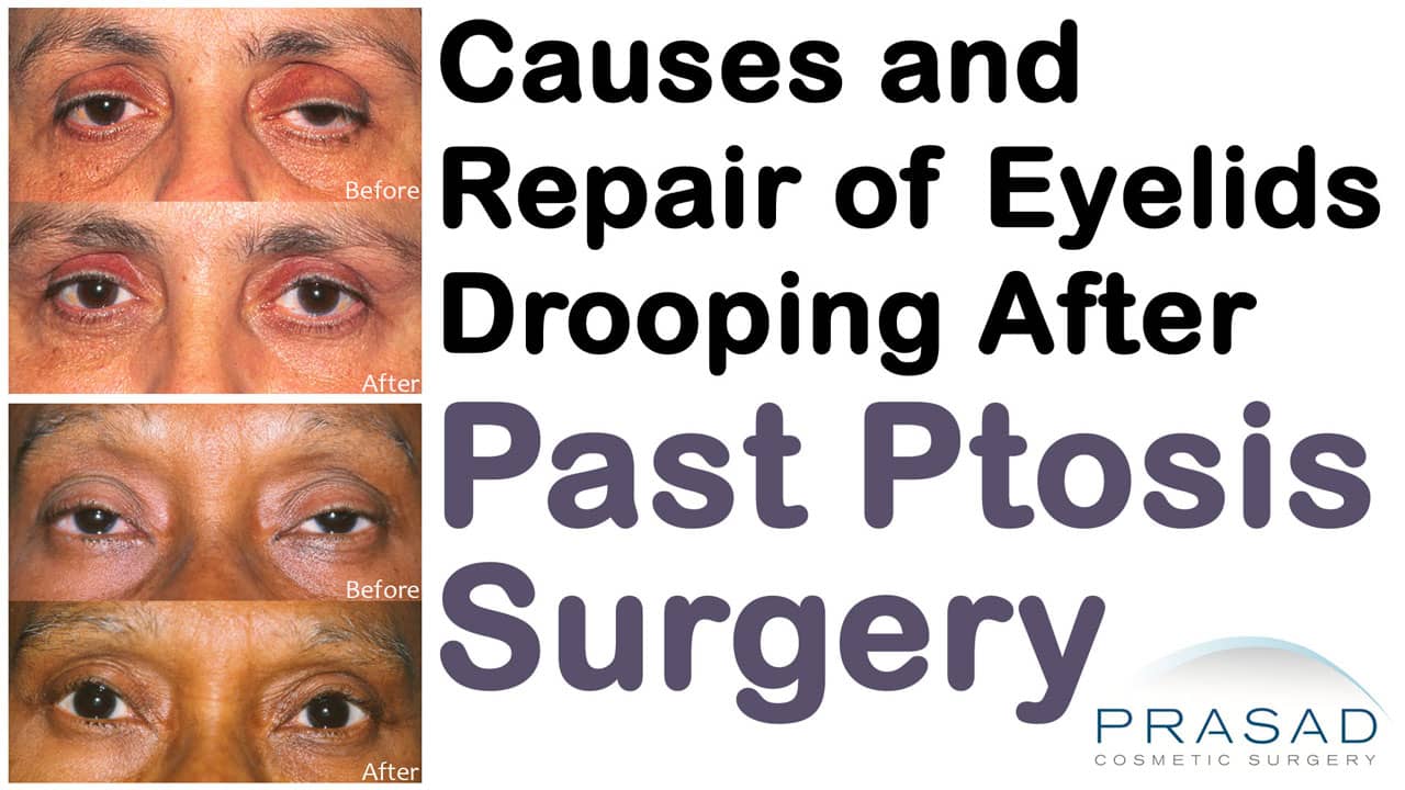 Ptosis Correction Surgery - Causes and Treatment | Dr Prasad Blog