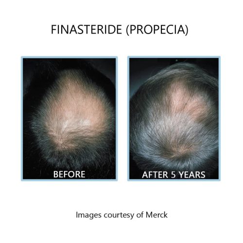 Understanding the Benefits and Risks of Finasteride in Women