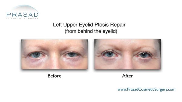Ptosis Correction Surgery - Causes and Treatment | Dr Prasad Blog