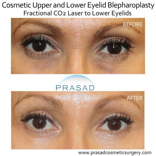 Laser Treatment for Dark Circles Under Eyes | Dr. Prasad Blog