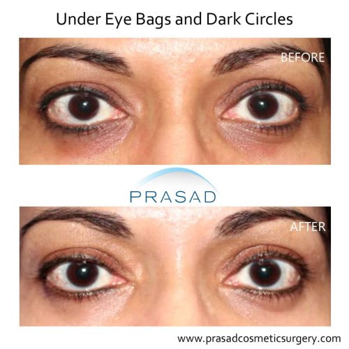 Treating Concurrent Under Eye Puffiness and Hollowness - Prasad ...
