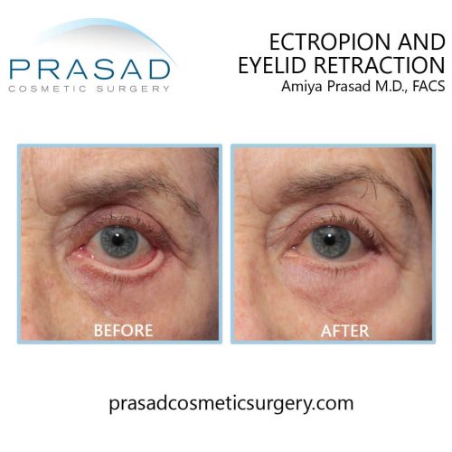 Eyelid Retraction: What It Is, Why It Happens, and How to Avoid It