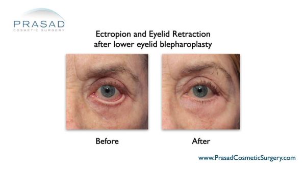 Eyelid Retraction: What It Is, Why It Happens, and How to Avoid It