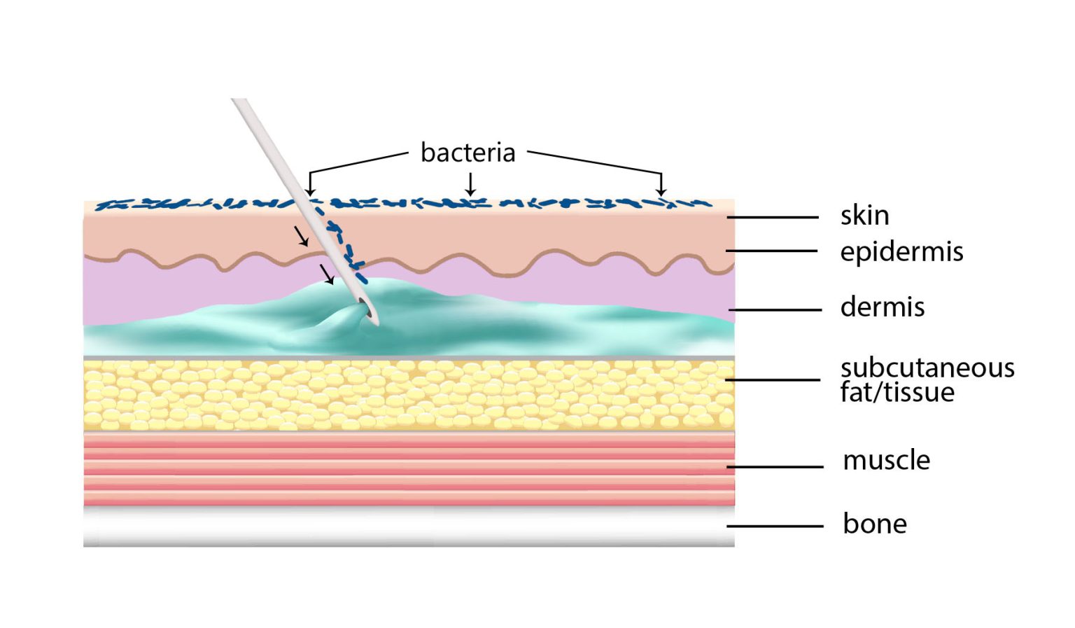 Semi-Permanent and Permanent Fillers: What You Need to Know