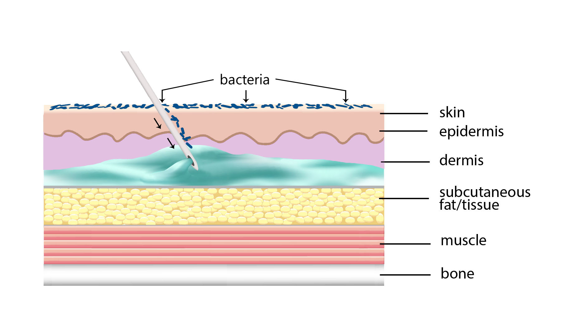 Semi-Permanent and Permanent Fillers: What You Need to Know