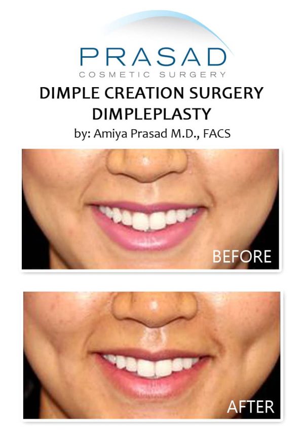 Dimple surgery | Dimple Creation Surgery - New York