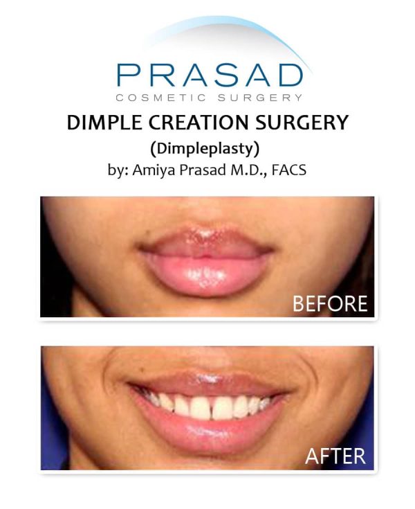 Dimple surgery | Dimple Creation Surgery - New York