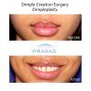 Dimple surgery | Dimple Creation Surgery - New York