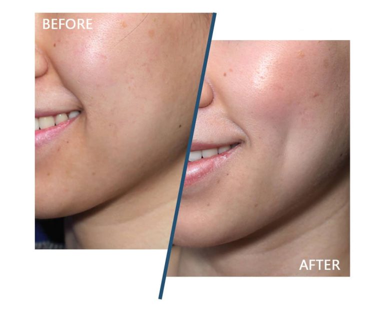 Dimple surgery | Dimple Creation Surgery - New York