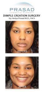 Dimple surgery | Dimple Creation Surgery - New York