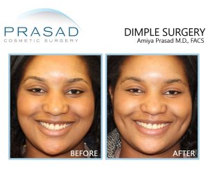 Dimple surgery | Dimple Creation Surgery - New York