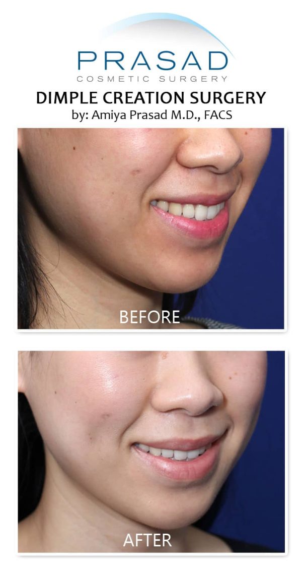 Dimple surgery | Dimple Creation Surgery - New York