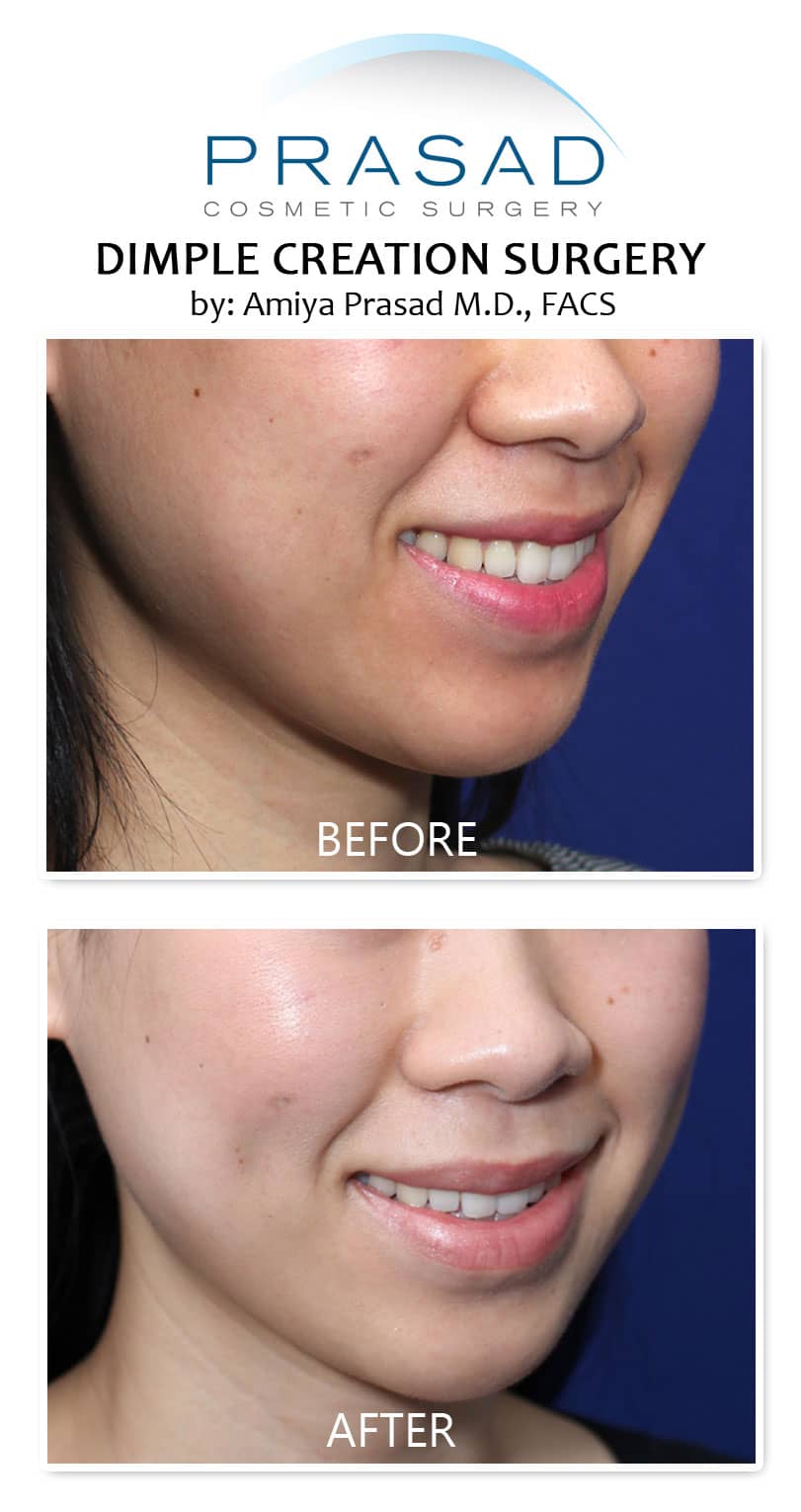 Dimple surgery | Dimple Creation Surgery - New York