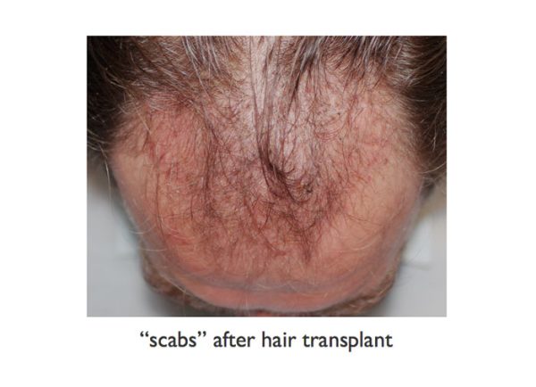 Hair Transplant Healing: What It's Like and How to Improve It