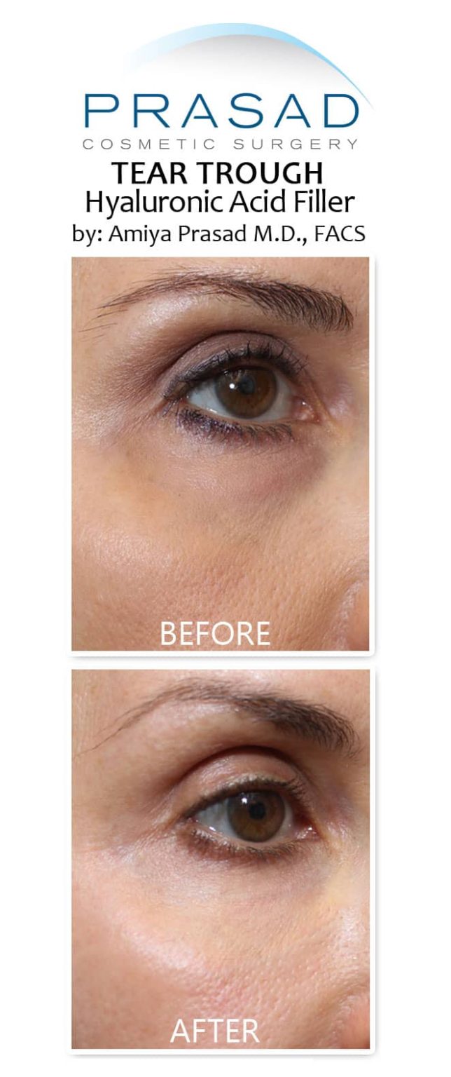 Under Eye Filler for Hollow Eyes, Tear Troughs and Eye Bags