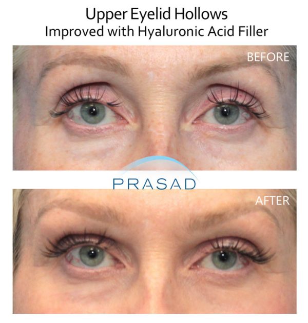 Upper Eyelid Hollow/ Lower Brow Hollowing Treatments - New York